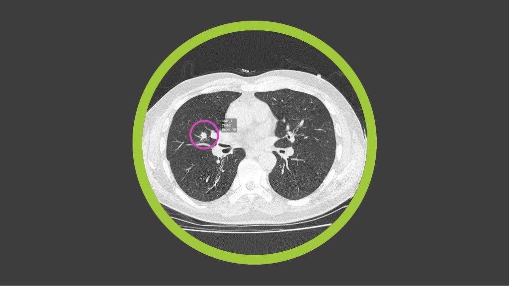 Optellum and J&J to Use AI to Transform Lung Cancer Treatment | Optellum
