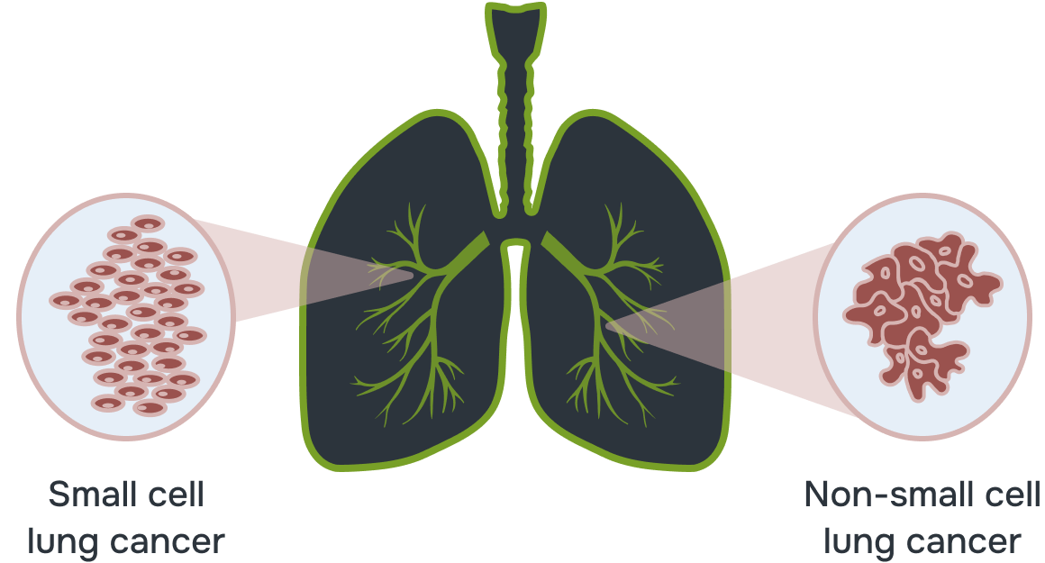 Optellum Lung Nodules